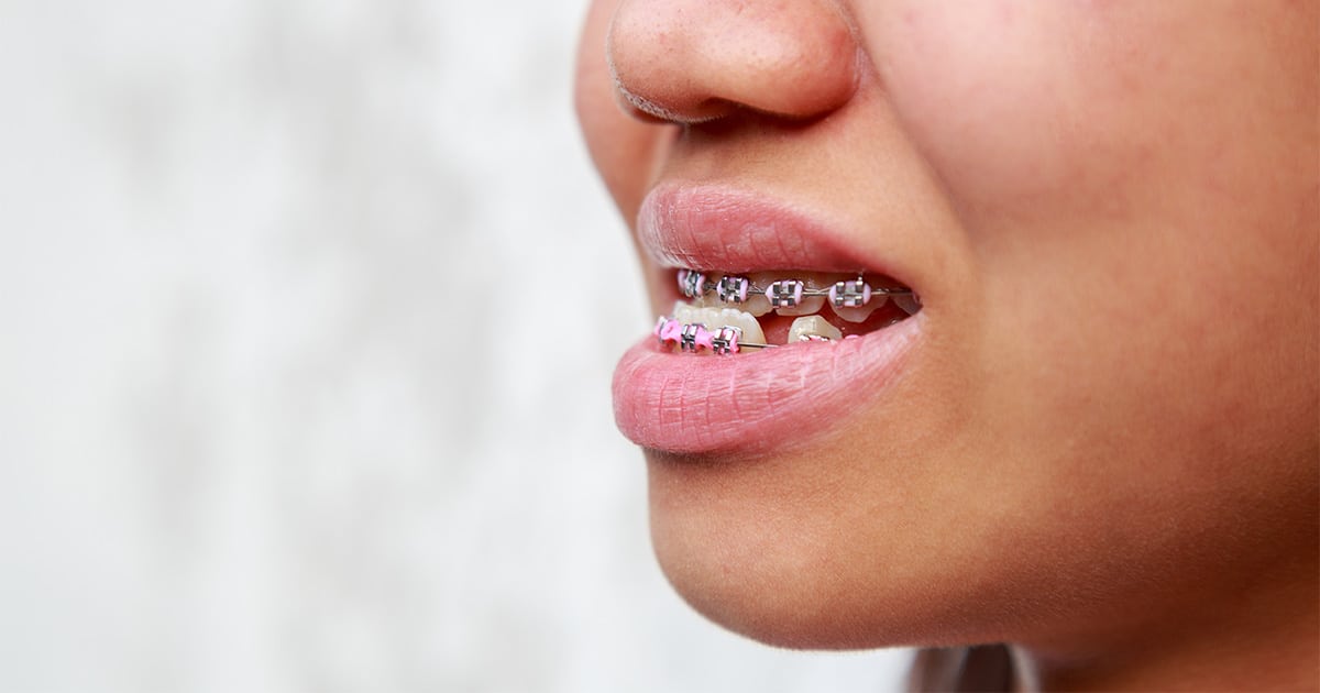A Protruding Lower Jaw is Something We Can Treat - Sawrie Orthodontics
